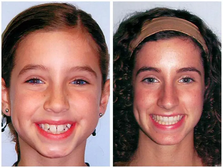 14 Personas a las que una operación de mandíbula les cambió la cara y ...