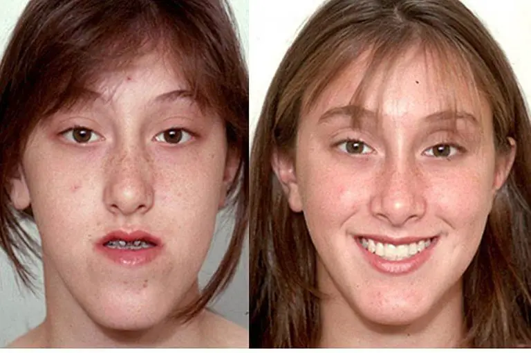 14 Personas a las que una operación de mandíbula les cambió la cara y ...