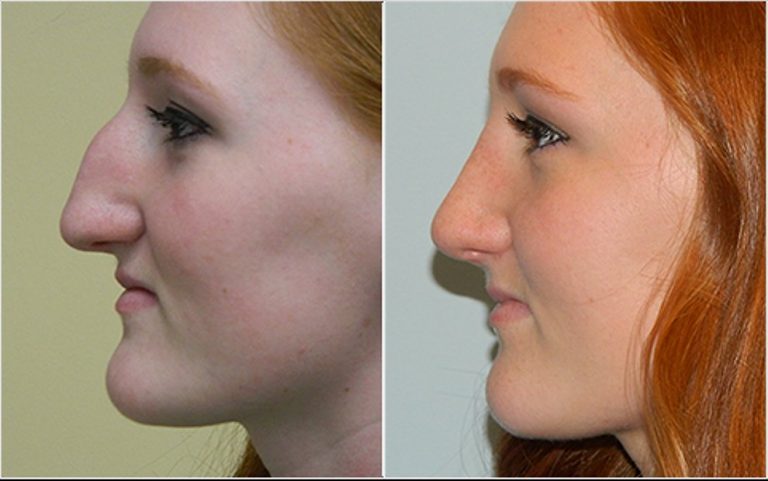 14 Personas a las que una operación de mandíbula les cambió la cara y ...