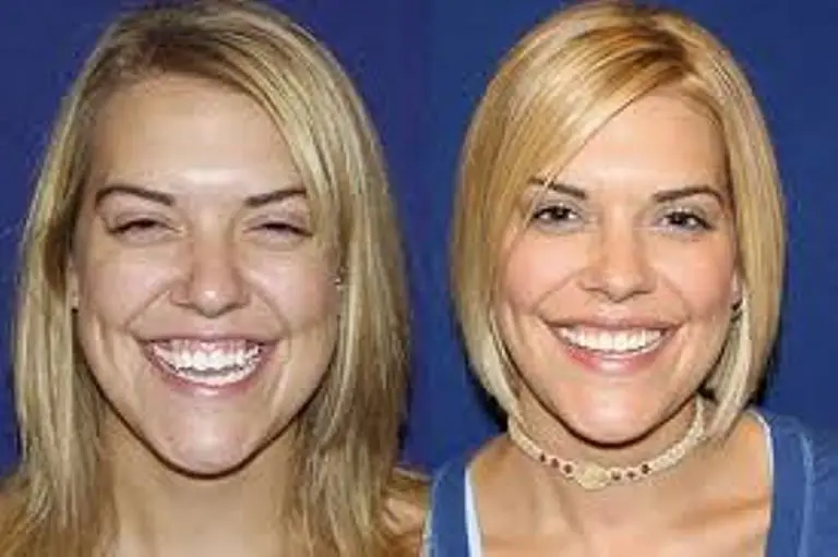 14 Personas a las que una operación de mandíbula les cambió la cara y ...