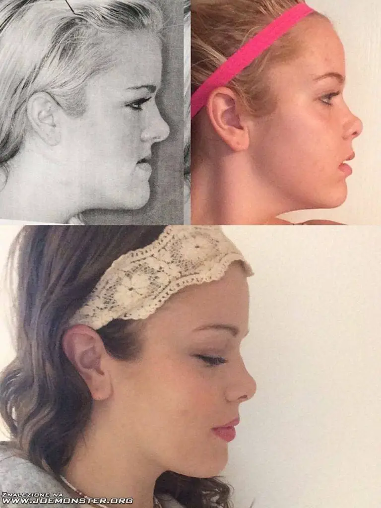 14 Personas a las que una operación de mandíbula les cambió la cara y ...