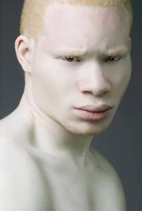 Así lucen los ALBINOS alrededor del mundo (+15 Fotos) | Difundir.ORG